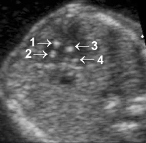 Case With Echogenic Foci Arrows 1 4 Download Scientific Diagram