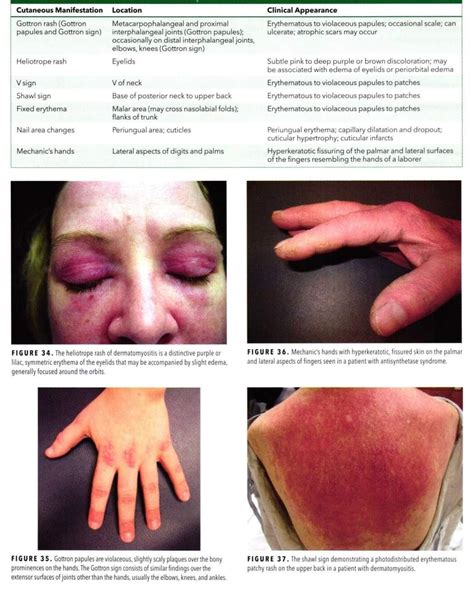 Gottrons Sign Adult Idiopathic Inflammatory Myopathies Medicine