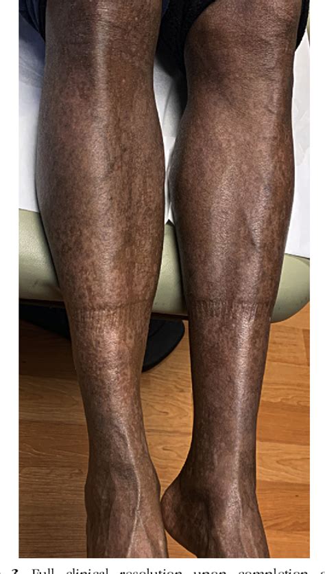 Figure 3 From Onset Of Rupioid Psoriasis After Vasodilatory Regimen