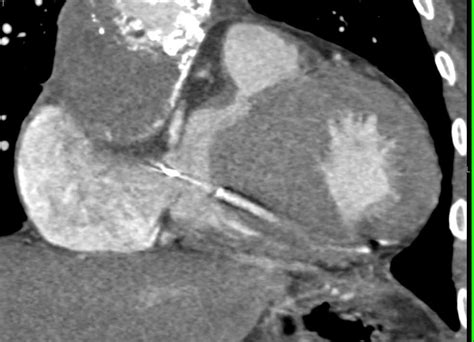 Angiosarcoma Involves The Right Side Of The Heart Cardiac Radiology