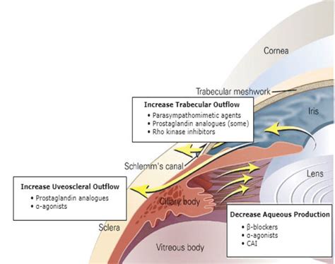 Glaucoma Update Looking Forward To 2023