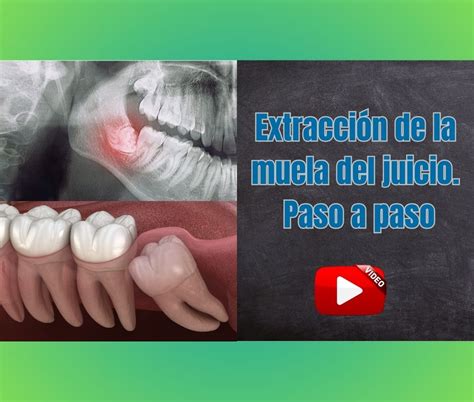Extracción De La Muela Del Juicio Paso A Paso Odontovida