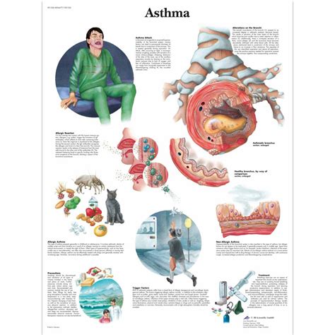 Asthma Chart Sem Trainers
