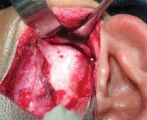 Two Horizontal Osteotomy Cuts Placed Download Scientific Diagram