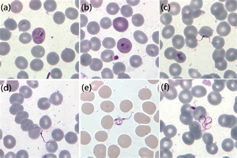 Plasmodium Vivax Thick Smear