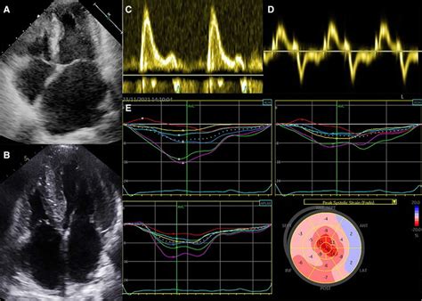 Restrictive Cardiomyopathy Causes Symptoms Diagnosis Treatment