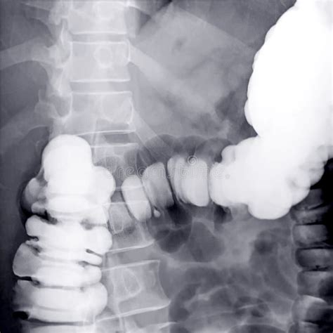 A Diagnostic Barium Enema Image Showing The Presence Of Diverticulosis