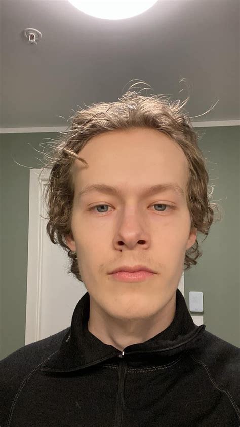 Premolar Extraction Retraction Victim What Should I Do Rjawsurgery