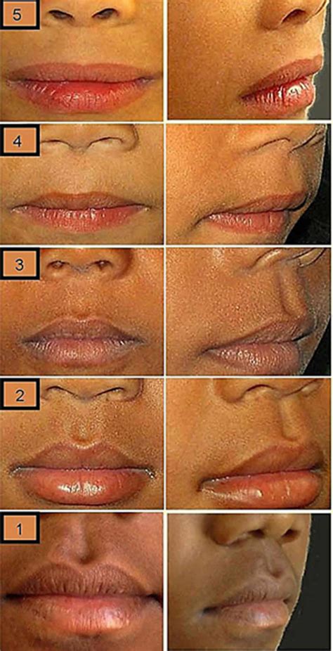 Philtrum Of Lip Causes Of Smooth Philtrum Long Or Short Philtrum