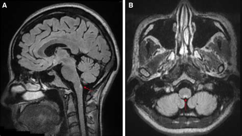 Area Postrema Syndrome A Neurological Presentation Of Nausea Vomiting