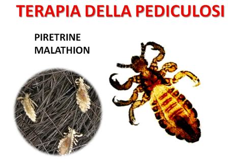 Pediculosi Del Capitis Lendini
