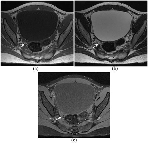 Pelvic Mri Images In Axial Section Showing The Right Ovary Lesion Download Scientific Diagram