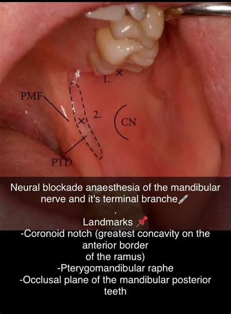 Inferior Alveolar Nerve Block Local Anesthesia Technique Jaypeedigital
