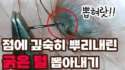 점에 깊숙하게 뿌리내린 굵은 털 뽑아내기 Youtube