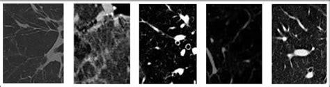 Figure 1 From Interstitial Lung Disease Detection Using Template