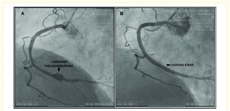 A Angiogram With The Pseudoaneurysm Before Treatment B Angiogram