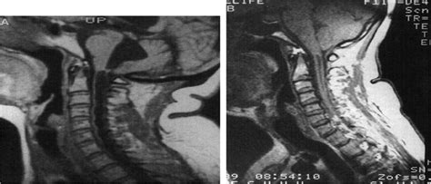 Surgical Treatment Of Syringomyelia Based On Magnetic Resona