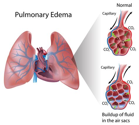 Pulmonary Edema Information Pulmonary Edema Zfczbq