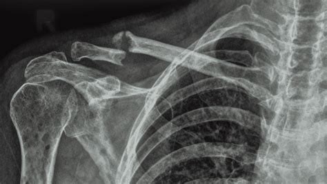 New Multiple Myeloma Therapy Sees Success In Over 70 Percent Of Patients Iflscience