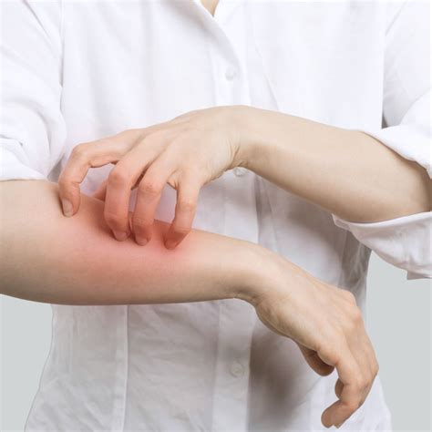 Eczema Treatment Singapore Healthsprings Medical Group