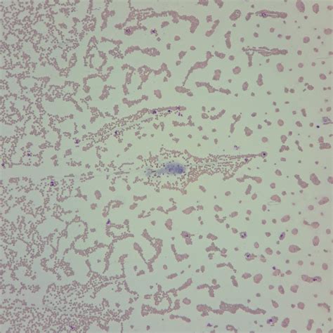 Platelets Giant And Large Clots And Clumps