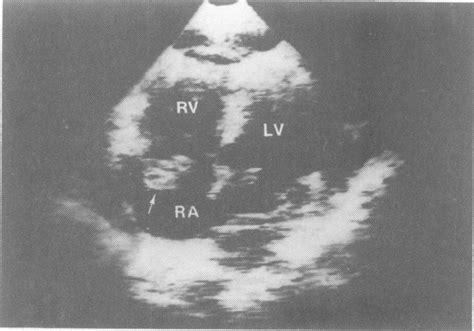 Case 3 Two Dimensional Echo Showing Large Free Floating Thrombus