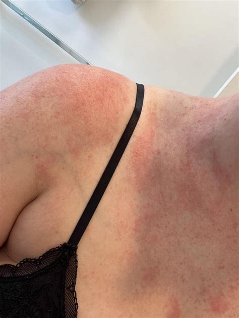 New Breakout Same Psoriasis Or New Eczema On Upper Body Rpsoriasis