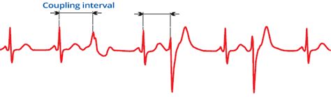 Premature Ventricular Complex Ecg Book