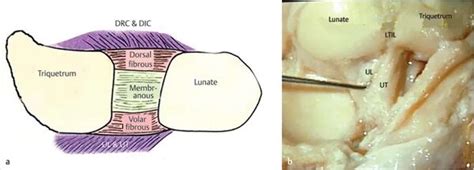 Lunotriquetral Joint Wikism Sports Medicine Wiki