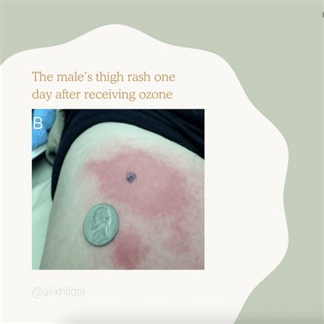 Ozone Therapy For Tick Bite Cellulitis More Info In The Comments R