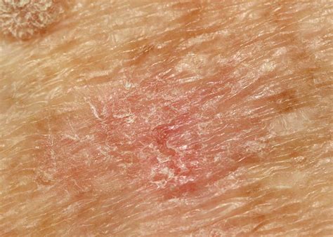 Actinic Keratosis Pictures