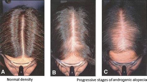 Thinning Hair And Female Hair Loss Causes Prevention Diagnosis And Treatment