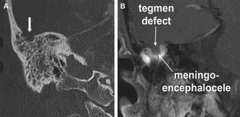 Common Otologic Surgical Procedures Neuroimaging Clinics