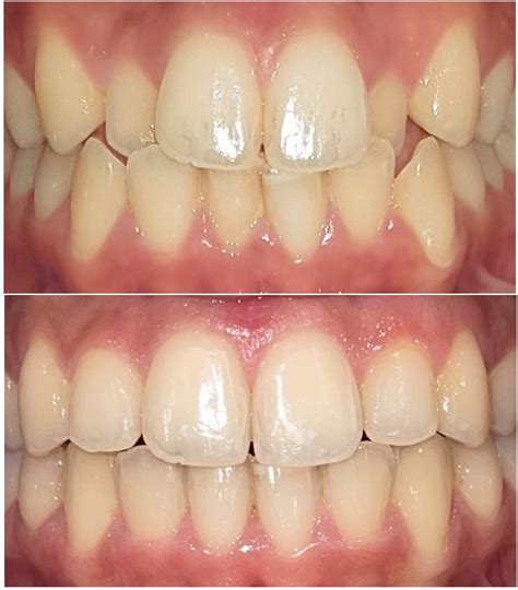 Teeth Correction Using Braces Before After Picture 1 Best