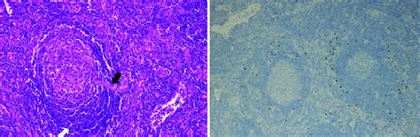 Histologic Features In Lymph Node Of Castleman Disease A Germinal