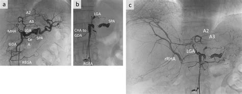 Preoperative Arterial Embolization To Alter Blood Flow A Angiography