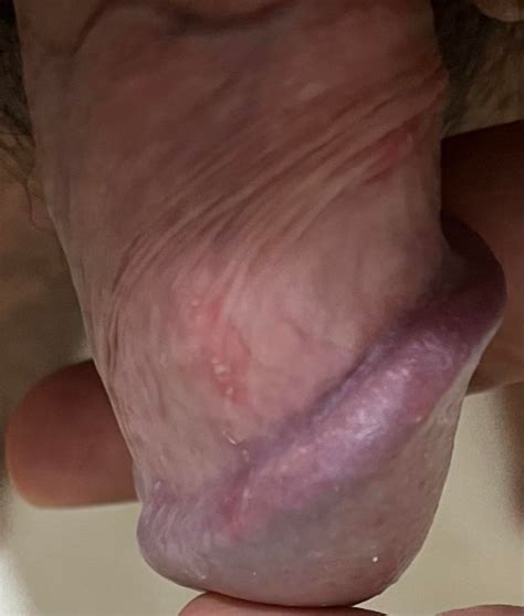 Does This Look Like Balanitis Rbalanitis