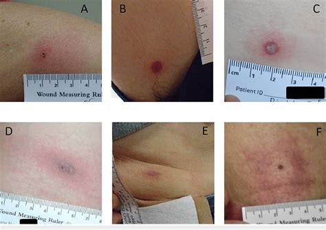 Normal Tick Bite Reaction Lyme Borreliosis Nature Reviews Disease
