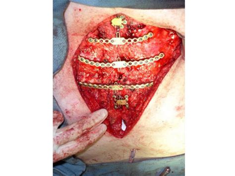 Sternum Plating System