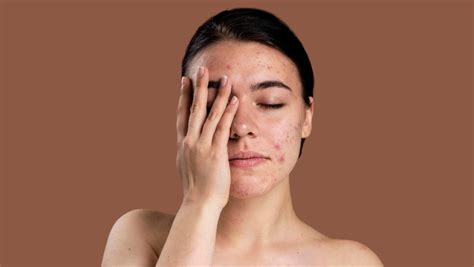 Reduce Itching On Face With Ayurveda Summer Remedies Teachers Grace