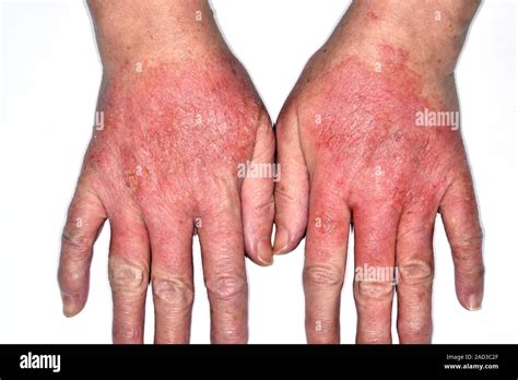 Infected Dermatitis Close Up Of Infected Inflamed Skin Dermatitis On
