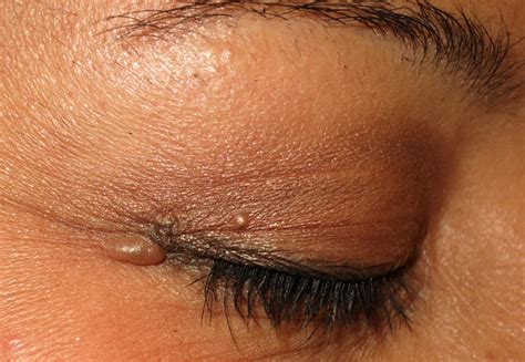 Small Bump On Eyelid