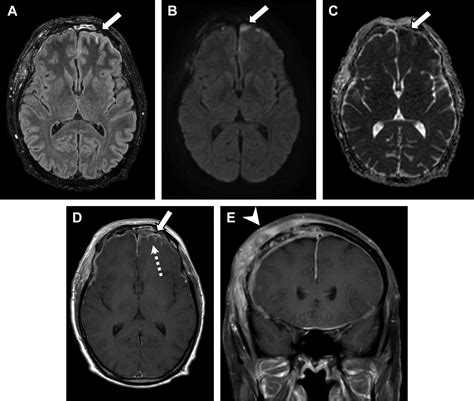 Bacterial Viral And Prion Infectious Diseases Of The Brain Magnetic