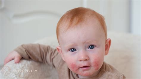 Atopijski Dermatitis Simptomi Lečenje I Kreme Apoteka Onlinea