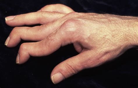 Superficialis Sling Flexor Digitorum Superficialis Tenodesis For Swan
