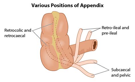 Symptômes De Lappendicite Causes Et Traitement De Lappendicite