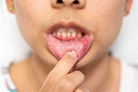 Comment Soigner Un Aphte Efficacement Astuces Et Conseils Pratiques Bpso