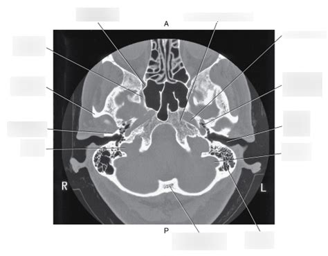 Internal Occipital Protuberance