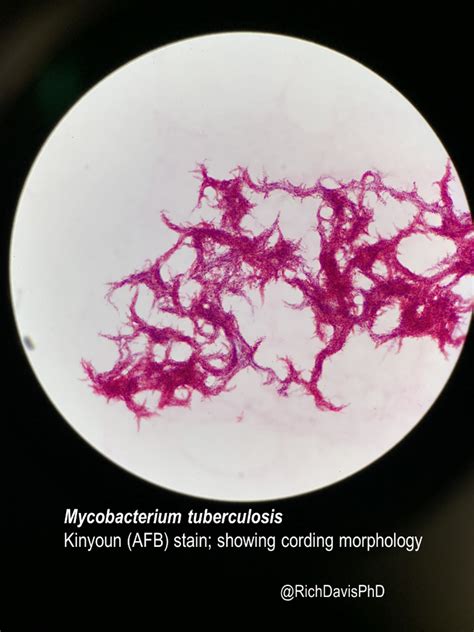 A Cording Too “cording” In Clinical Isolates Of Mycobacterium Lablogatory