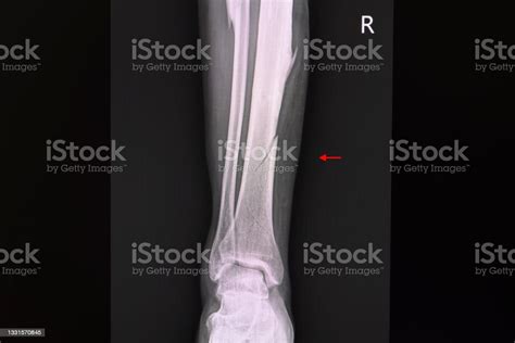 Xray Film Of A Patient With Closed Non Displaced Spiral Fracture Of